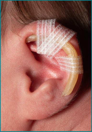 Non-Surgical Treatments for Congenital Ear Differences: A Guide for Parents